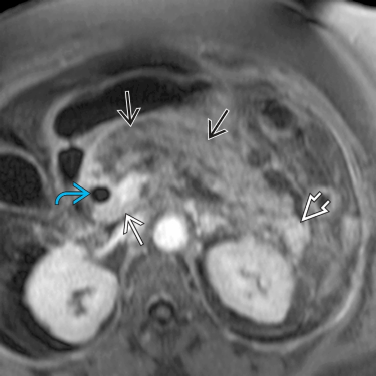 Acute Pancreatitis | Radiology Key