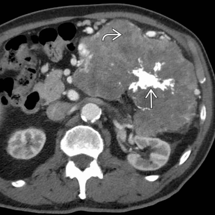 Serous Cystadenoma of Pancreas | Radiology Key