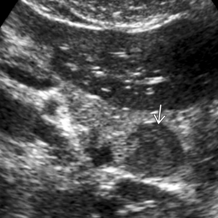 Pancreatic Neuroendocrine Tumor | Radiology Key