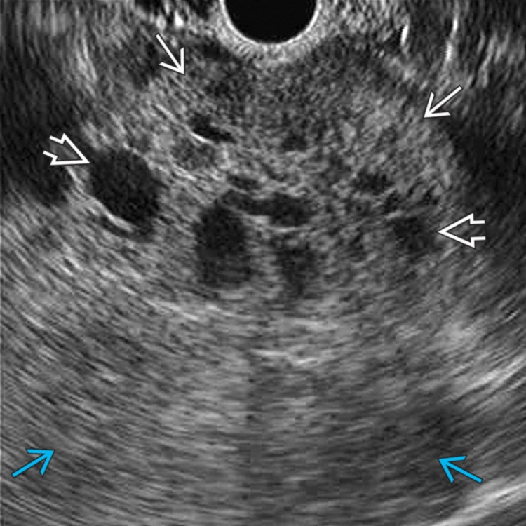 Solid Pseudopapillary Neoplasm | Radiology Key