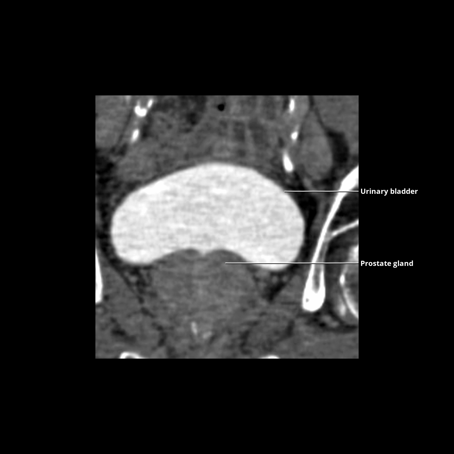Ureters and Bladder | Radiology Key