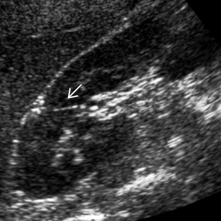 Renal Junctional Line | Radiology Key