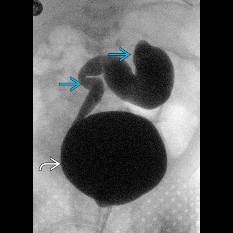 Renal Ectopia | Radiology Key