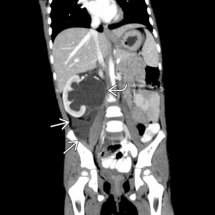 Ureteropelvic Junction Obstruction | Radiology Key
