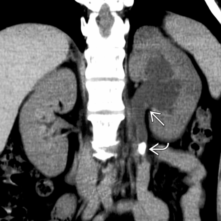Urolithiasis | Radiology Key