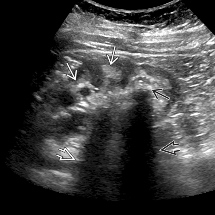 Nephrocalcinosis | Radiology Key