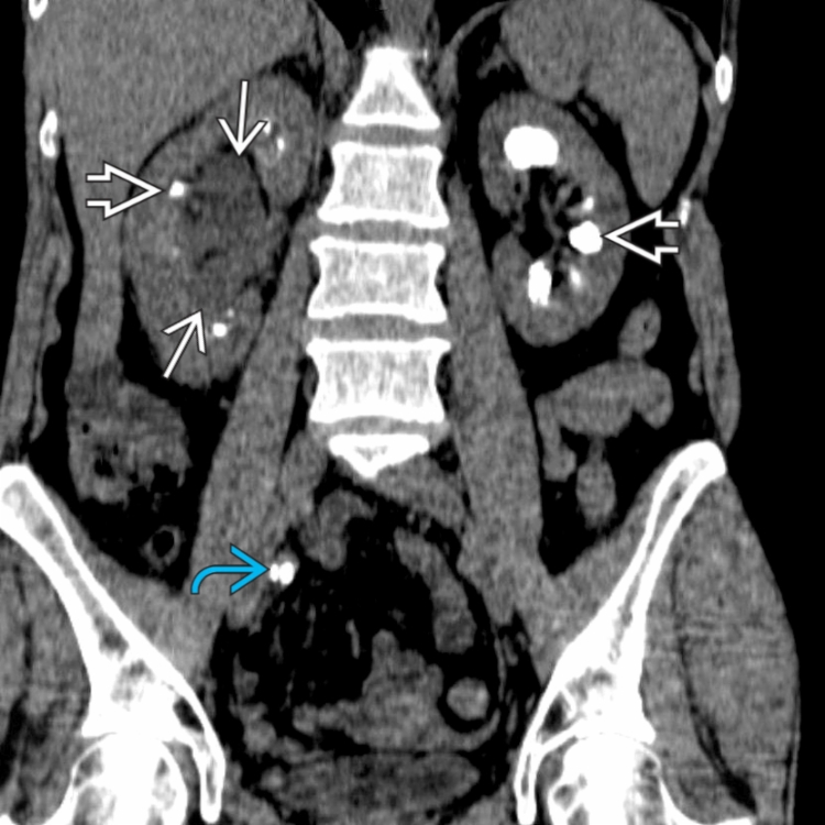 Hydronephrosis | Radiology Key