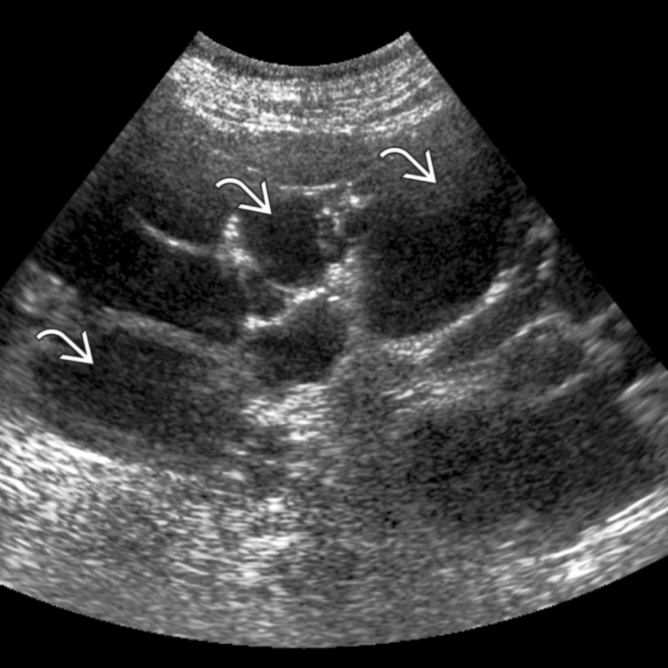 Simple Renal Cyst | Radiology Key