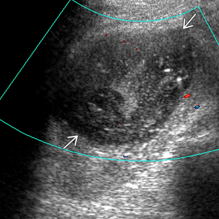 Complex Renal Cyst | Radiology Key