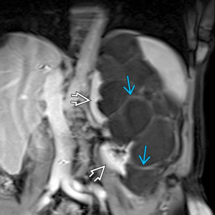 Multilocular Cystic Nephroma | Radiology Key