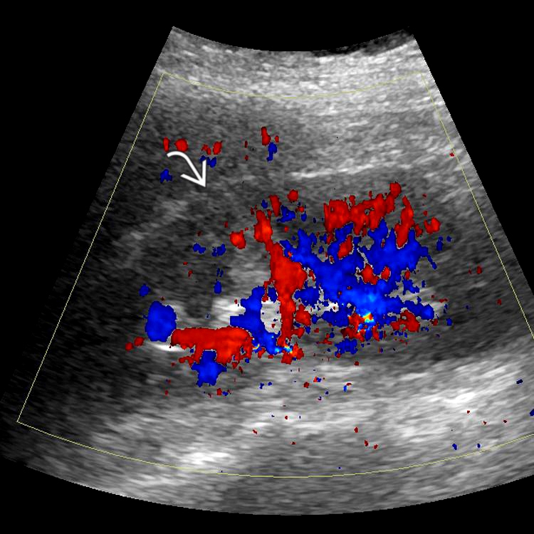 Acute Pyelonephritis | Radiology Key