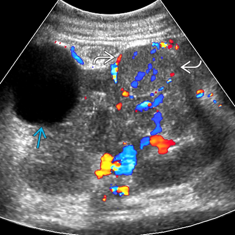 Renal Angiomyolipoma | Radiology Key