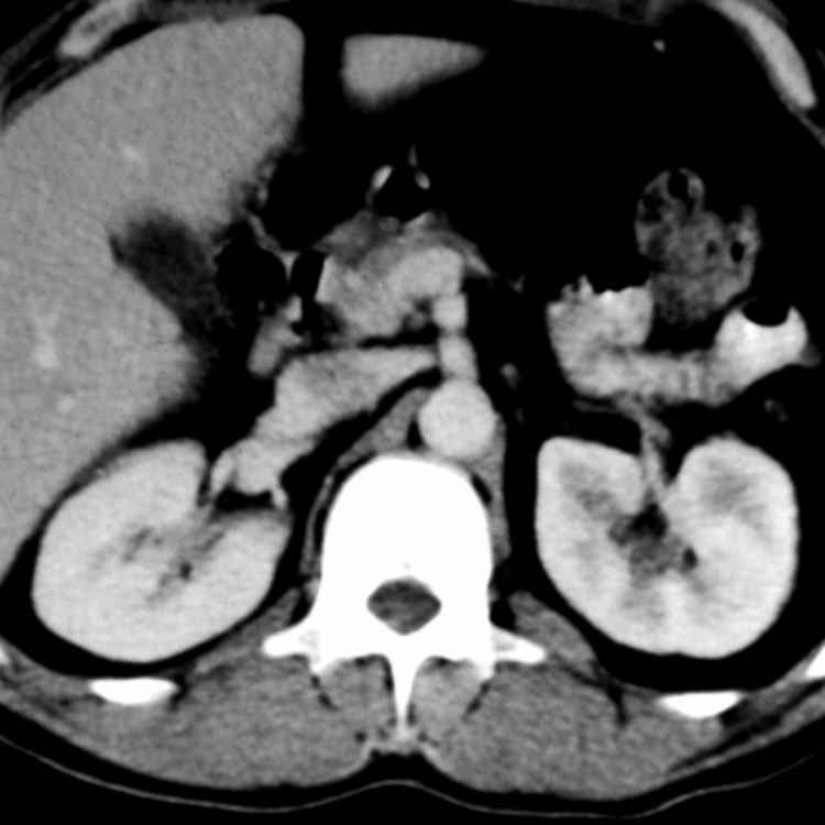 Renal Vein Thrombosis | Radiology Key