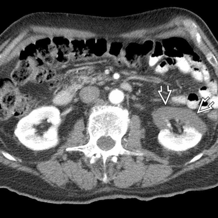 Renal Infarct | Radiology Key