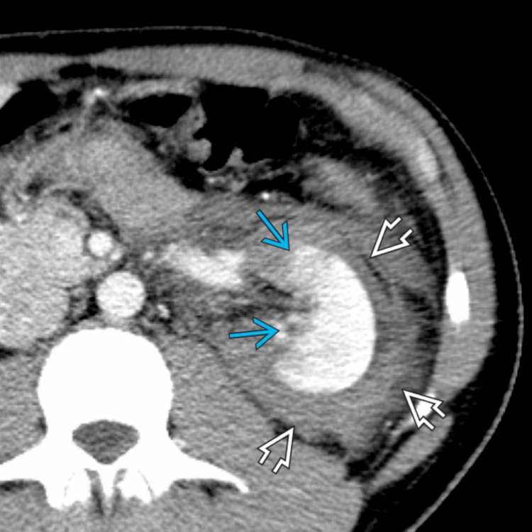 Perinephric Hematoma | Radiology Key