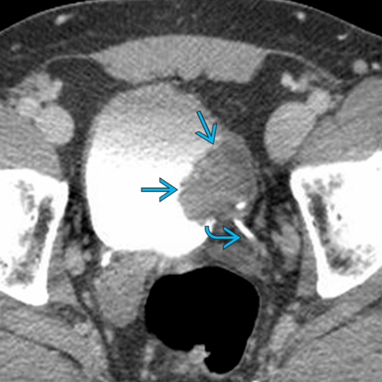 Bladder Carcinoma | Radiology Key
