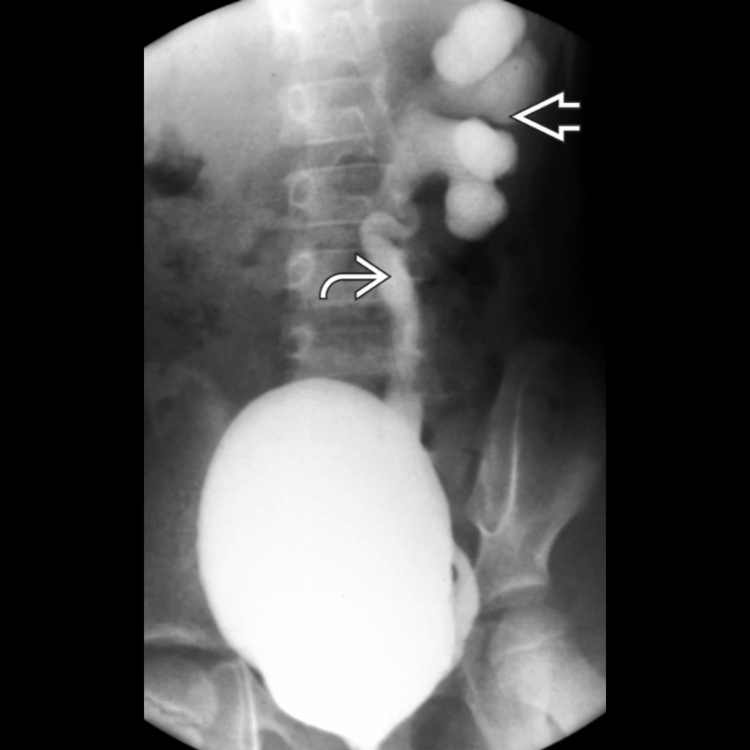 Ureterocele | Radiology Key