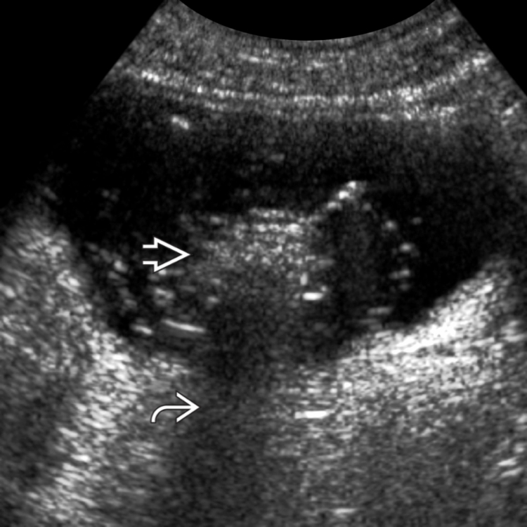 Bladder Calculi | Radiology Key