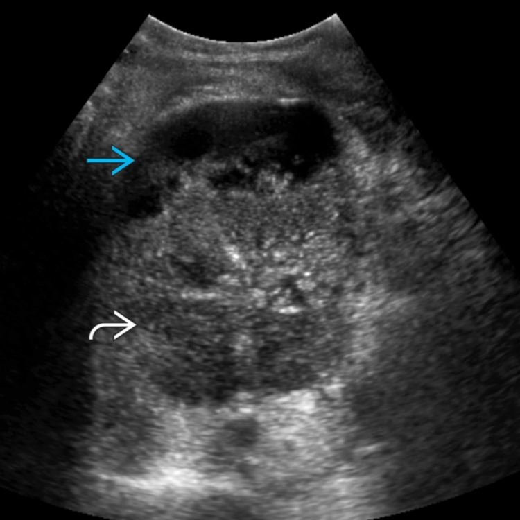 Perigraft Fluid Collections | Radiology Key