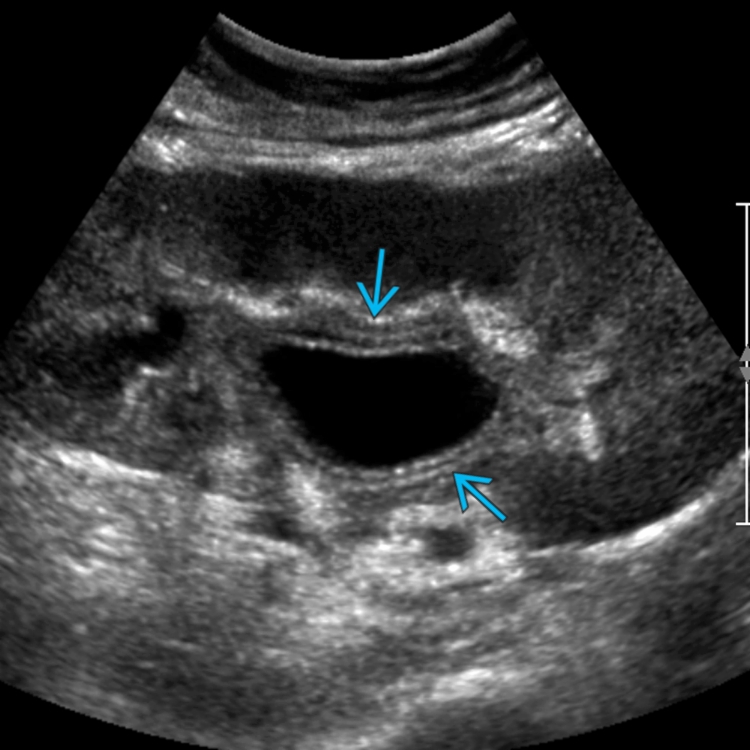 Renal Transplant Hydronephrosis | Radiology Key