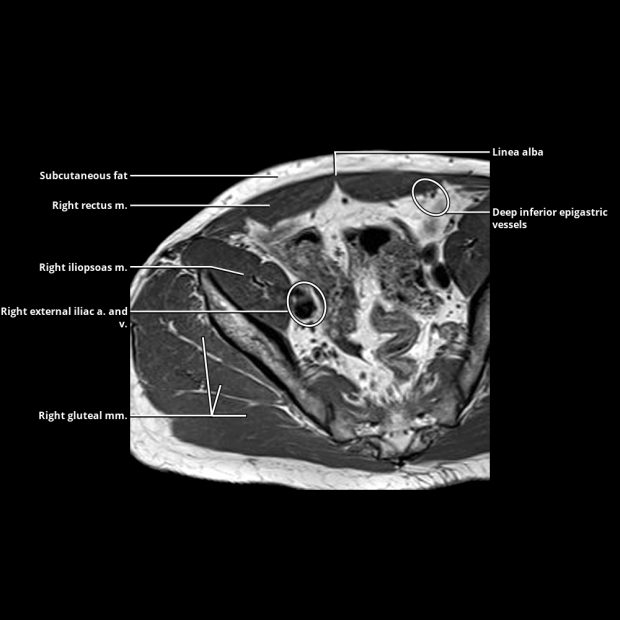 Epididymitis/Orchitis | Radiology Key