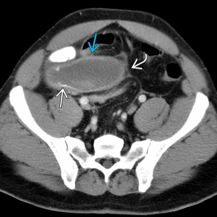 Appendiceal Mucocele | Radiology Key
