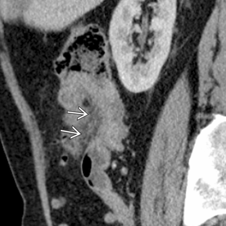 Intussusception | Radiology Key