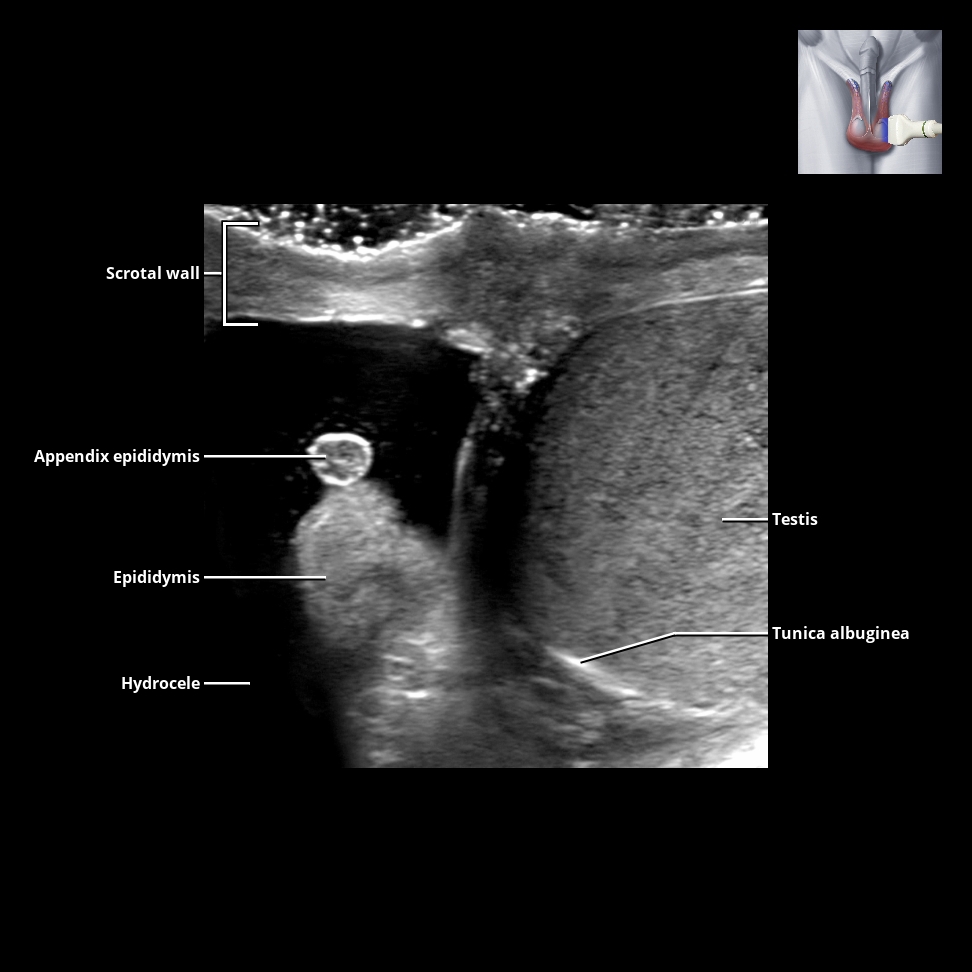 Testes and Scrotum | Radiology Key