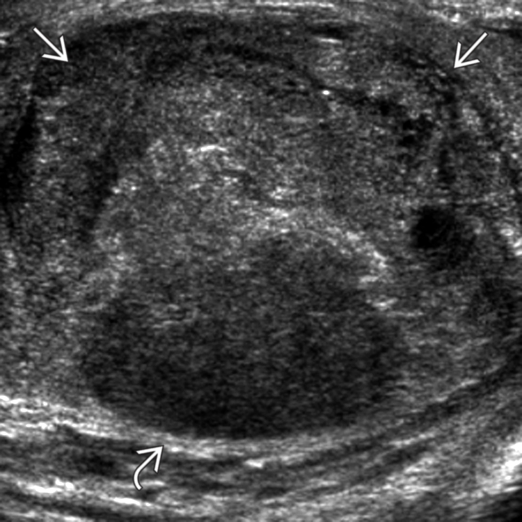 Testicular Germ Cell Tumors Radiology Key 3880