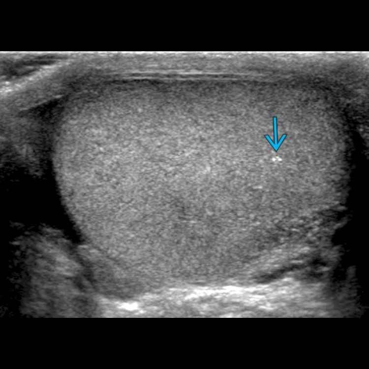 Testicular Microlithiasis | Radiology Key