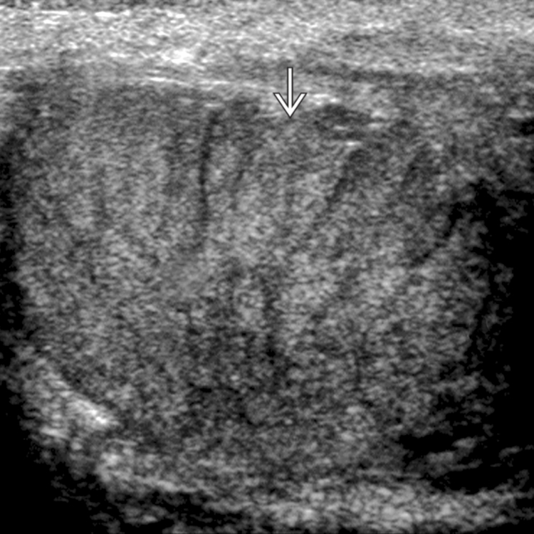Testicular Torsion/Infarction | Radiology Key