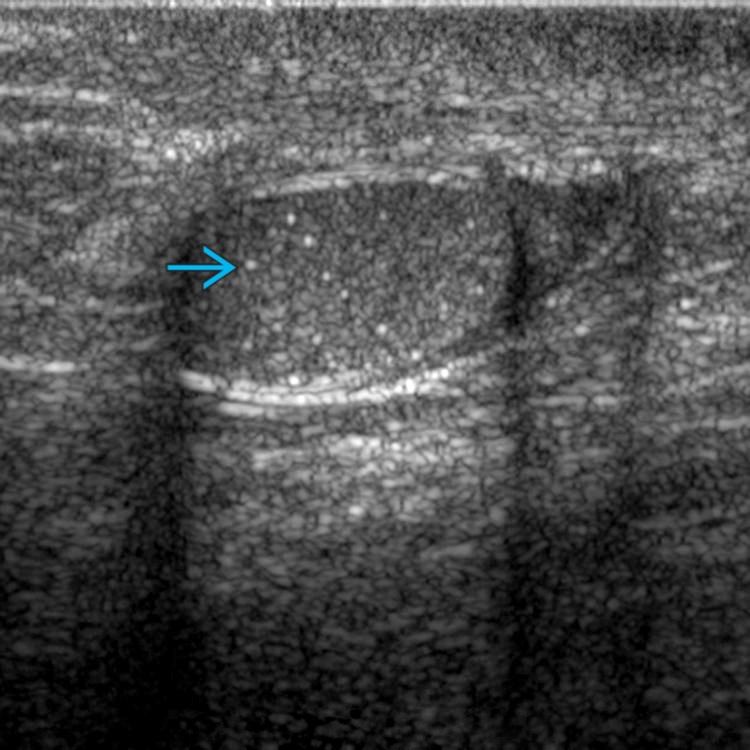 Undescended Testis | Radiology Key