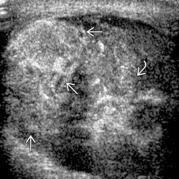 Scrotal Trauma | Radiology Key