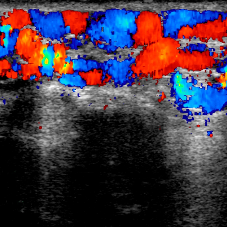 Varicocele | Radiology Key