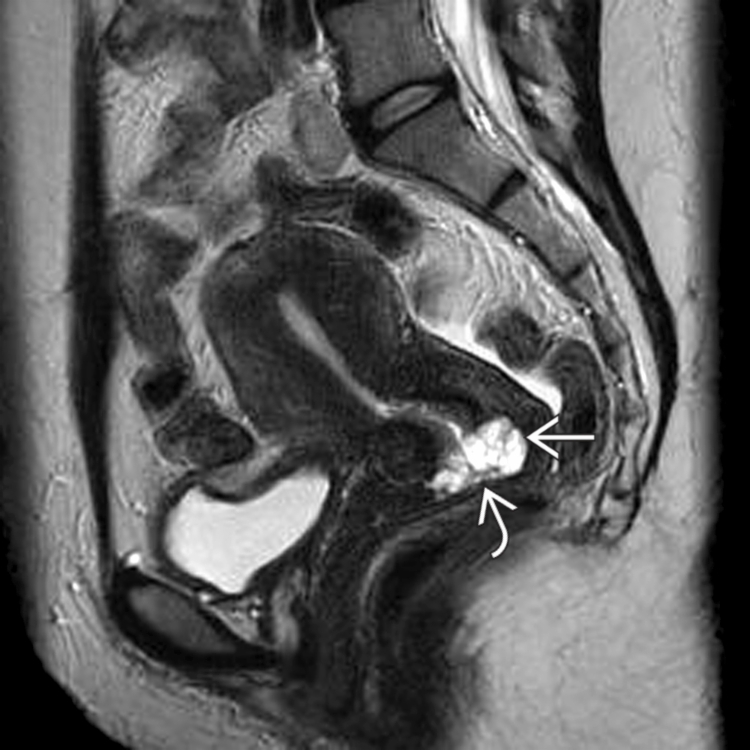 Nabothian Cyst | Radiology Key