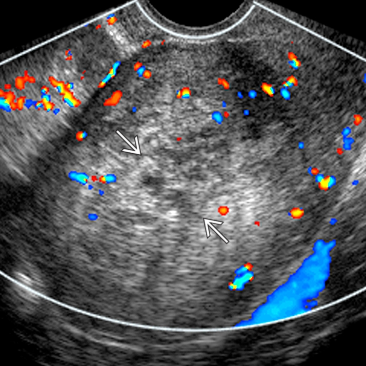 Endometritis | Radiology Key