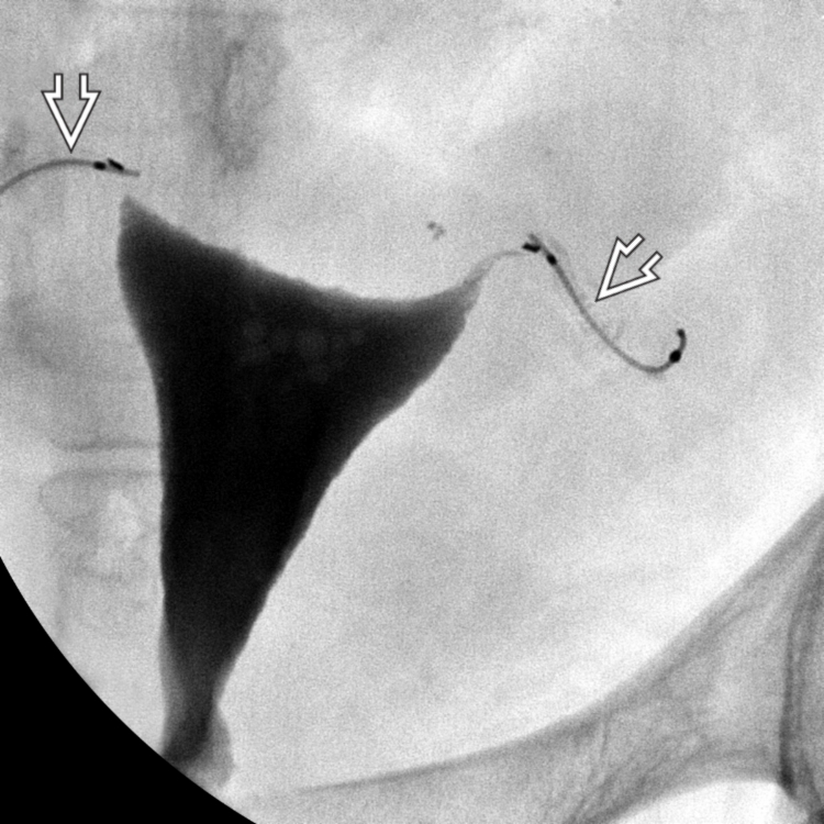 Intrauterine Device | Radiology Key