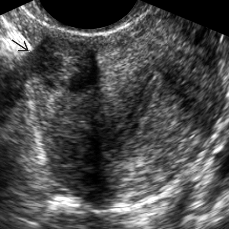 Endometrioma | Radiology Key