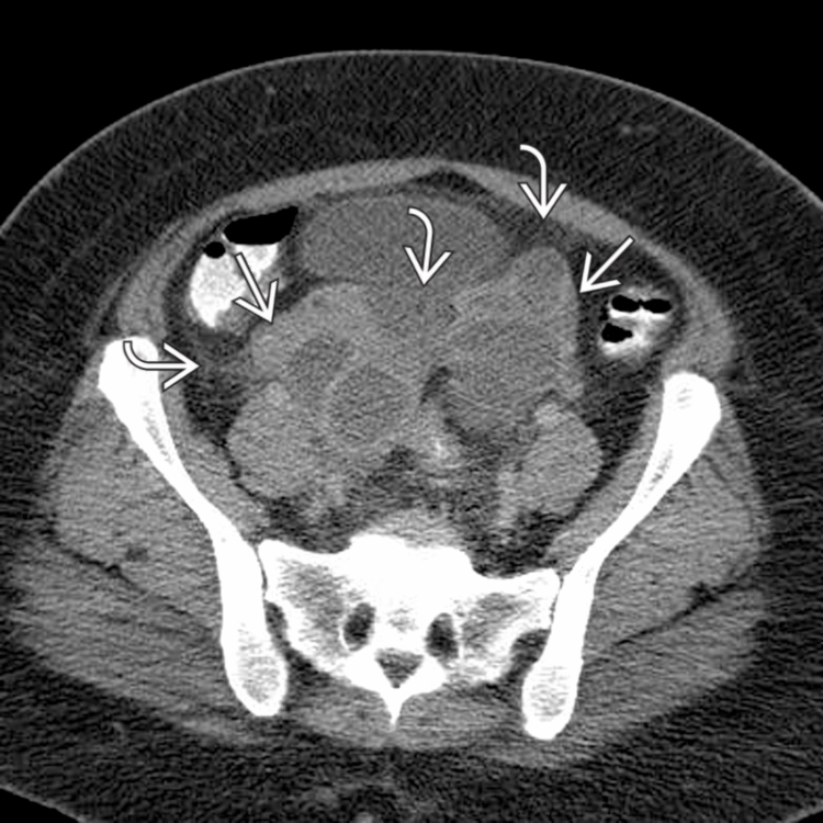 Tuboovarian Abscess | Radiology Key