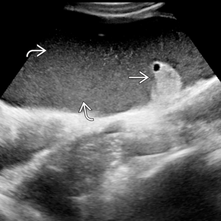 Peritoneal Inclusion Cyst | Radiology Key