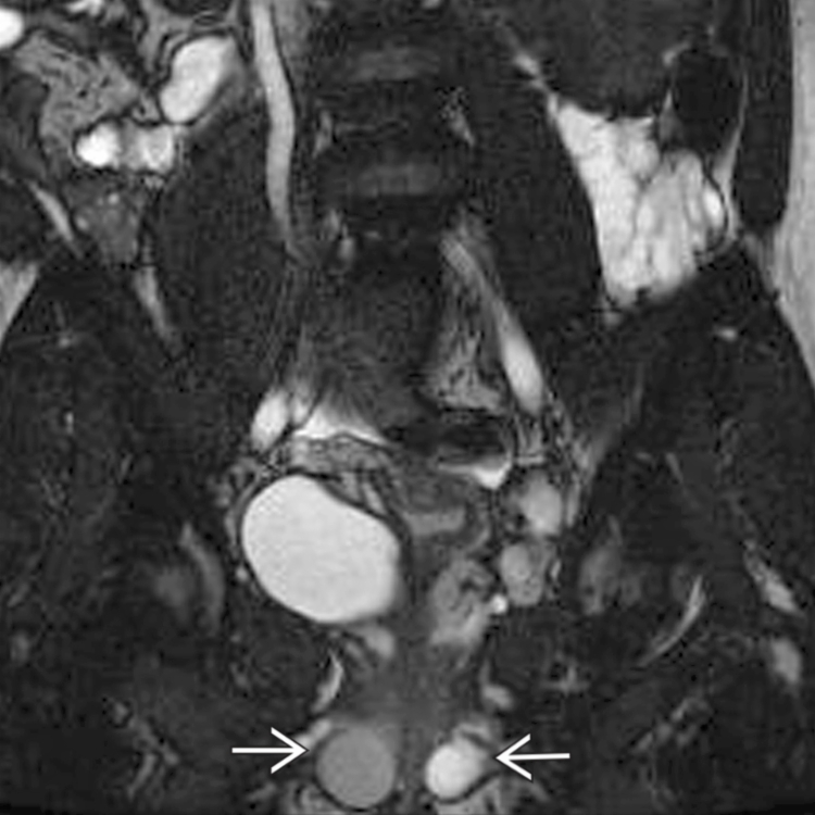 Bartholin Cyst | Radiology Key