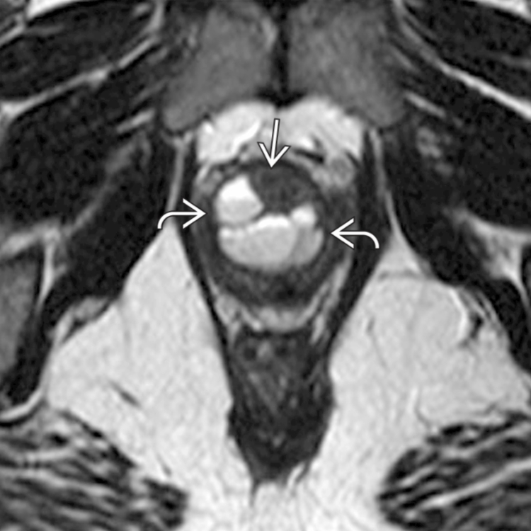Gartner Duct Cyst | Radiology Key
