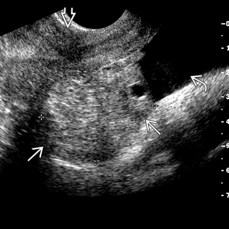 Adnexal/Ovarian Torsion | Radiology Key