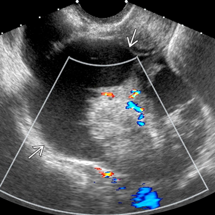 Ovarian Metastases Including Krukenberg Tumor | Radiology Key