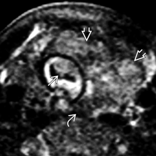Cystic Hygroma | Radiology Key