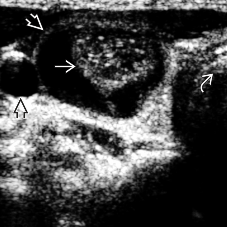 Multinodular Goiter | Radiology Key