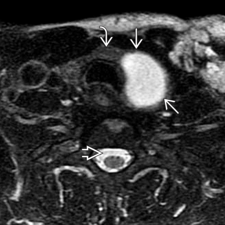 Colloid Cyst of Thyroid | Radiology Key