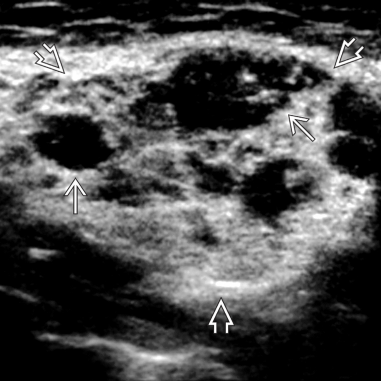 Submandibular Sialadenitis | Radiology Key