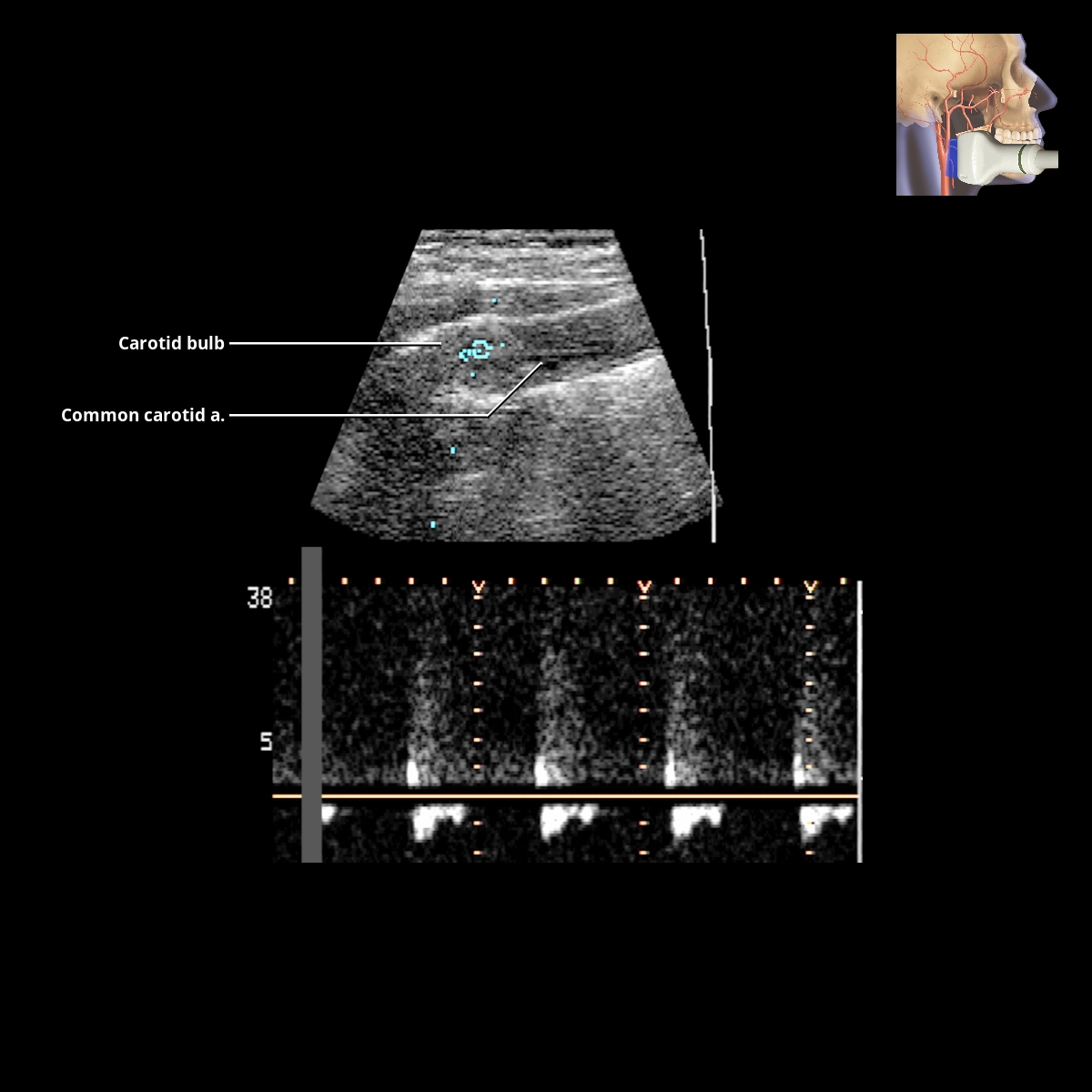 Carotid Arteries | Radiology Key