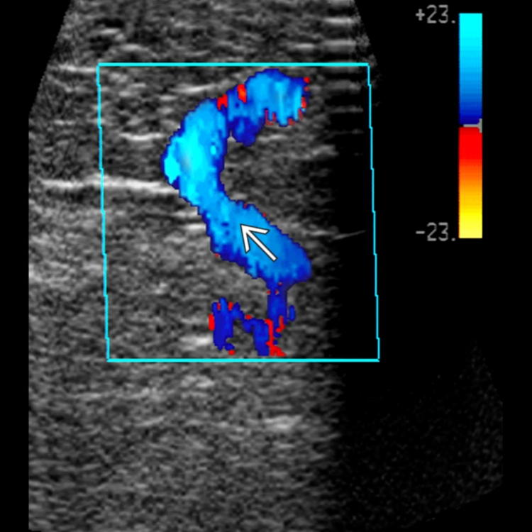 Varicose Veins/Incompetent Perforator | Radiology Key